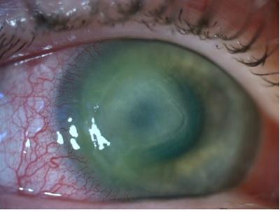 bacterial keratitis imaging faster assessment | University of Southampton